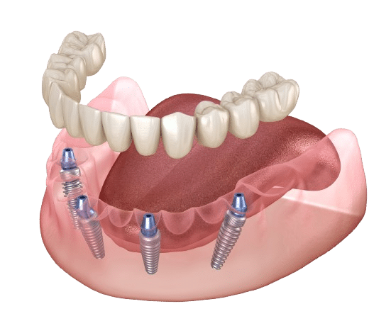 Implant-Supported Dentures in Erie, PA To Restore Your Smile